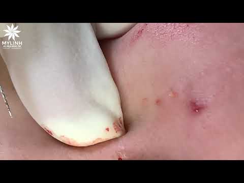 BLACKHEADS AND ACNE REMOVAL #75 | Lấy mụn ẩn dưới da, mụn đầu đen | 黑頭和粉刺去除 | 0934000075