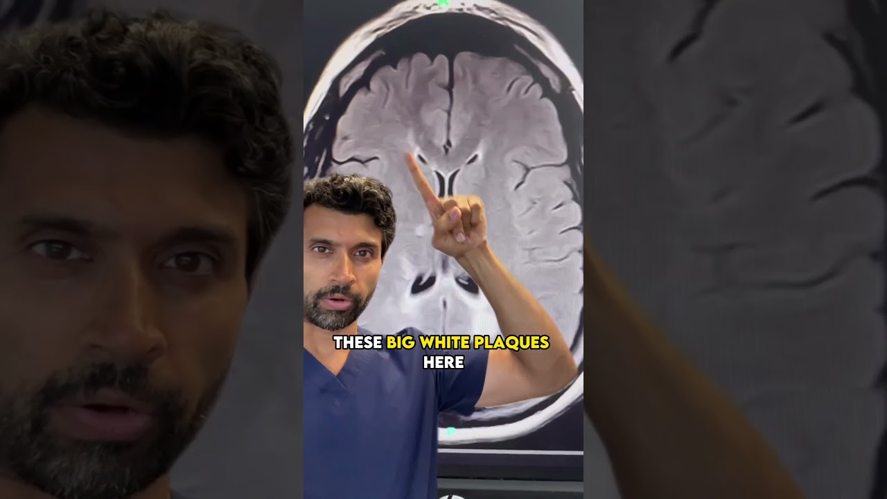 OPTIC NERVE MISTERY #shorts  #doctor #eyedoctor #eyecondition #eyes #ophthalmologist #eyemovement
