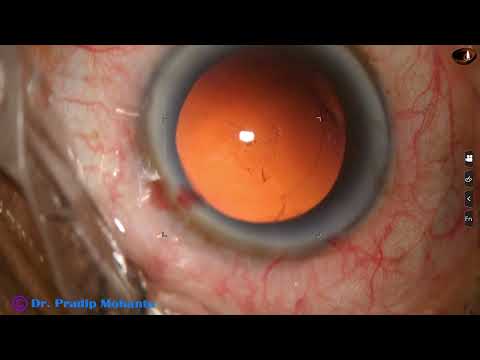 Phaco of cataract with gr 3 + Nuclear sclerosis - unedited video : Pradip Mohanta, 7th Oct, 2022