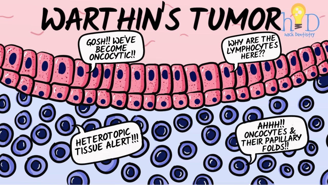 Warthin's tumor