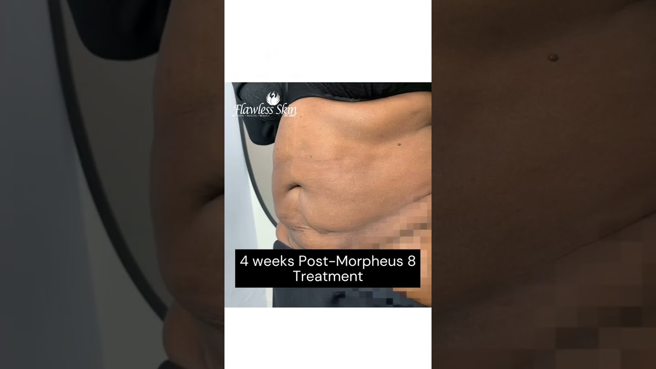 Belly fat reduction & skin tightening with Morpheus 8 after ONE SESSION!