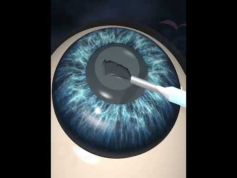 Human Eye cataract surgery 6