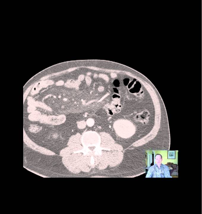 Sclerosing Mesenteritis CT.mp4