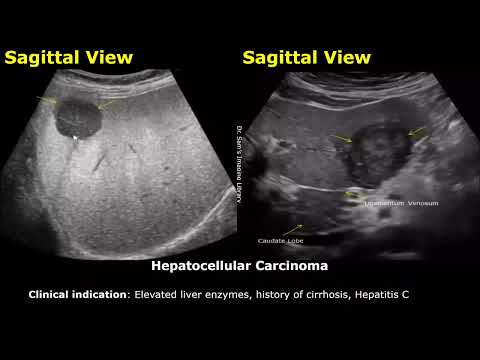 Liver Ultrasound Reporting | Liver Diseases Scan Reports | How To Write USG Report | Abdominal USG