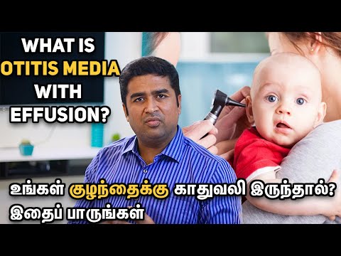 What is Otitis Media with Effusion OME?| Dr. Vignesh Gokul ENT Doctor