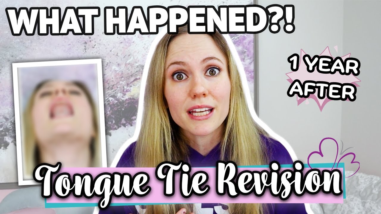 Adult TONGUE TIE RELEASE Update // What happened??