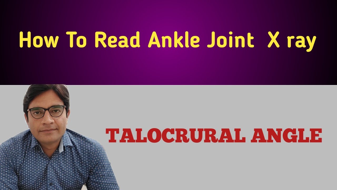 How To Measure TALOCRURAL ANGLE On Ankle X ray