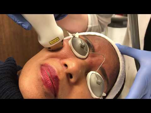 ICON 1540 Fractional Laser Treatment - Dr. Anthony Youn