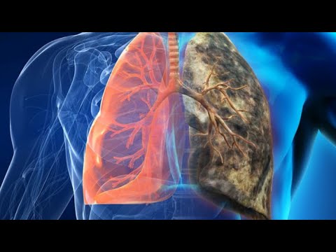 Oncology for Non-Oncologists – Lung Series – PART 1 of 2
