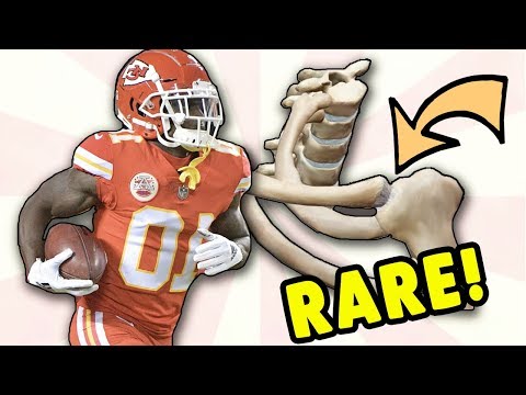 Tyreek Hill Hospitalized with RARE Shoulder Injury! Doctor Explains SC Dislocation