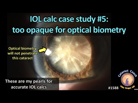 CataractCoach 1588: IOL calc case study 5: too opaque for optical