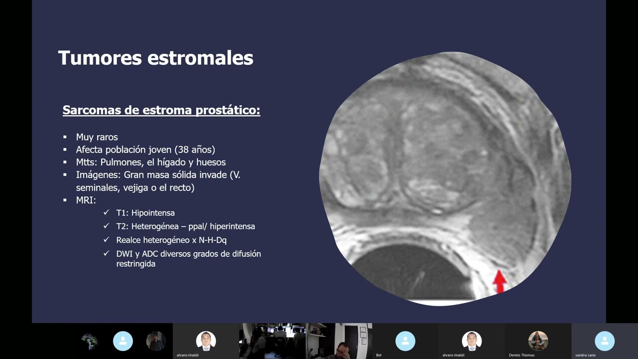 Neoplasia Mesenquimal de Prostata y Vesiculas Seminales