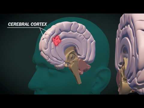 What is glioblastoma?