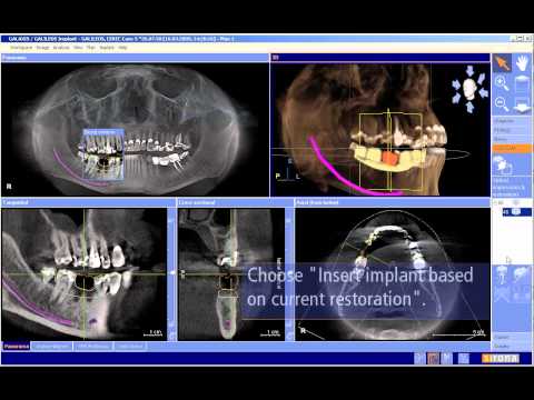 cerec meets galileos software tutorial en
