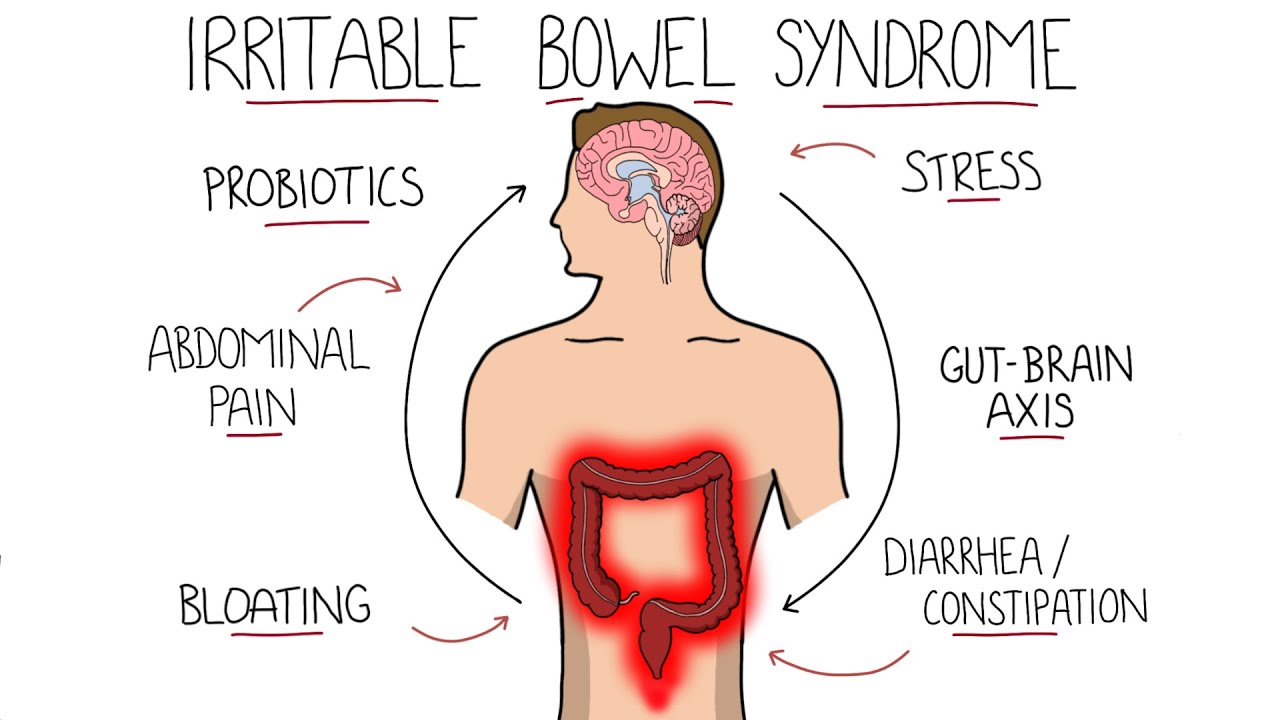 Irritable Bowel Syndrome (IBS) - Including Symptoms, Criteria & Treatment!