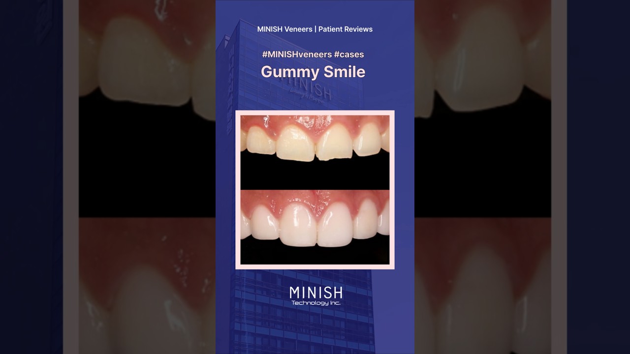 Gummy Smile Repaired with Gum Contouring + MINISH Veneers Case