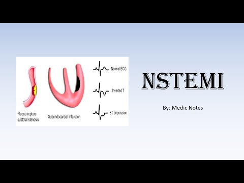 NSTEMI (non-ST elevation myocardial infarction) - investigations, management