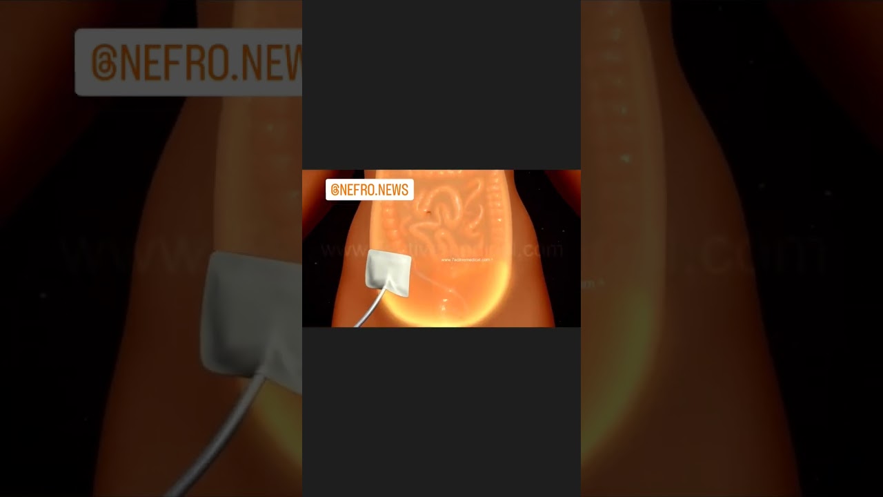 Diálise Peritoneal
