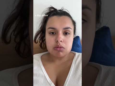 My Wisdom Teeth Recovery in 30 seconds 🦷| #wisdomteeth #surgeryrecovery #dayinthelife