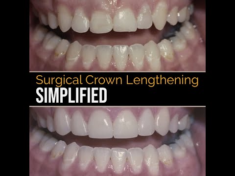 S4351 - Surgical Crown Lengthening Simplified