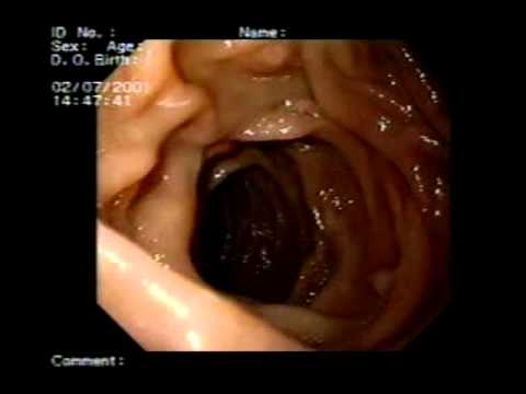 Diagnostic Gastroscopy