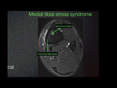 Sports Medicine Case 36: 16-year-old: Soccer Player with Bilateral Exertional Leg pain.