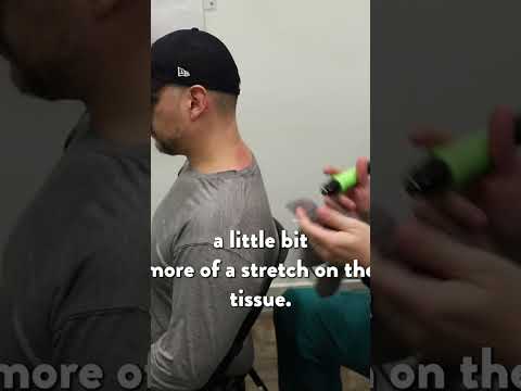 It’s not the Upper Traps, it’s Levator Scapula Causing Your Neck Pain