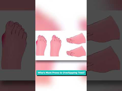 Overlapping Toes: Causes and Solutions #shorts