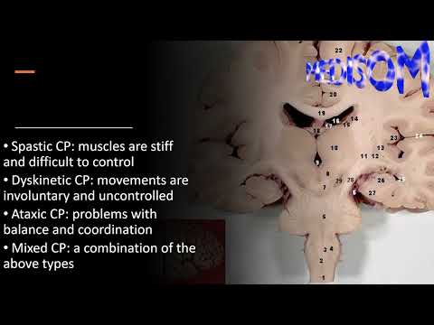 AF SOMALI CUDURKA CEREBRAL PALSY