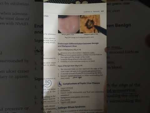 endoscopic differentiation between benign and malignant ulcer #endoscopy #ulcers