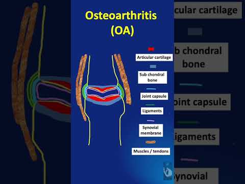 Shorts # 129: Osteo Arthritis in the hand and fingers (OA) - The Clinical features, Heberden nodes