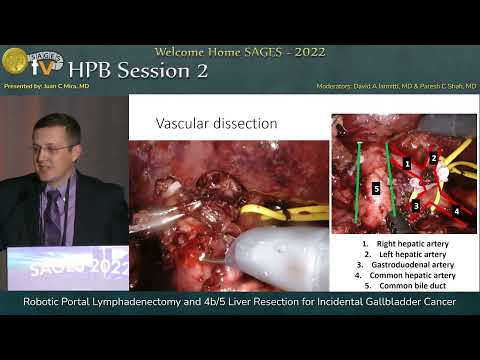 Robotic Portal Lymphadenectomy and 4b/5 Liver Resection for Incidental Gallbladder Cancer