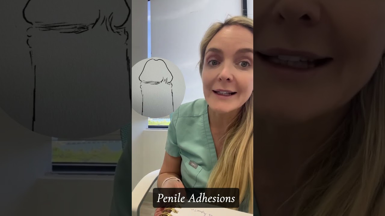 All About Penile Adhesions