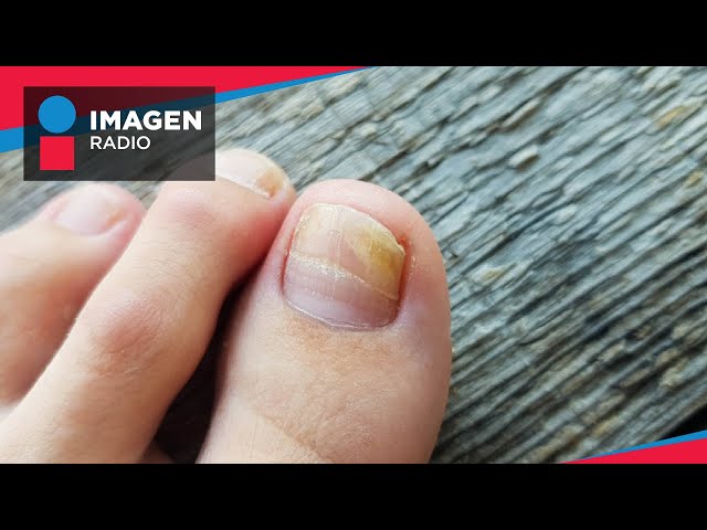 ¿Cómo se deben curar las uñas encarnadas?