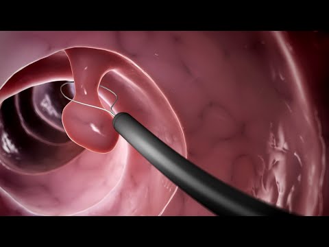 Study on Colonoscopic Polypectomy in Children