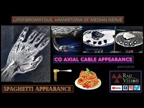 Co-axial cable appearance and Spaghetti 🍝 appearance in LFH -Classic book picture case.
