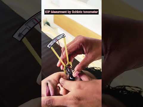 IOP measurement with Schiotz tonometer.
