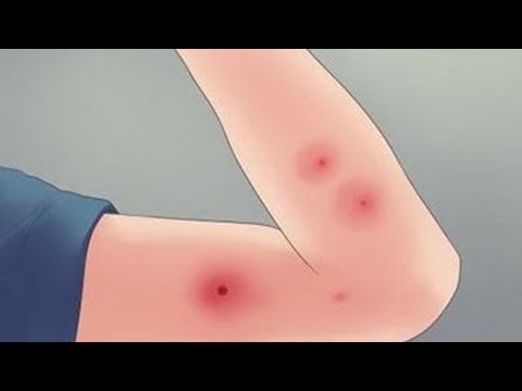 ¿Qué es la ENFERMEDAD de LYME?