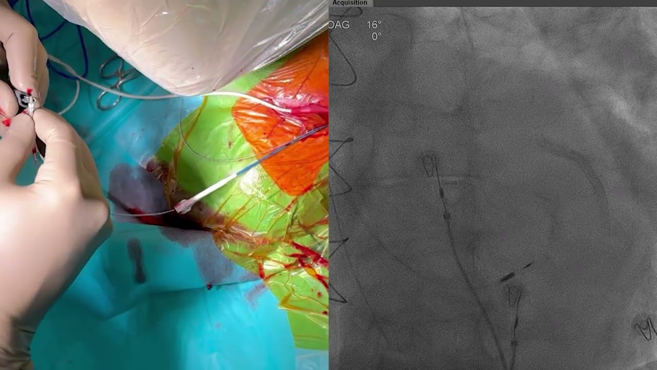 Left bundle branch area pacing with lumenless lead