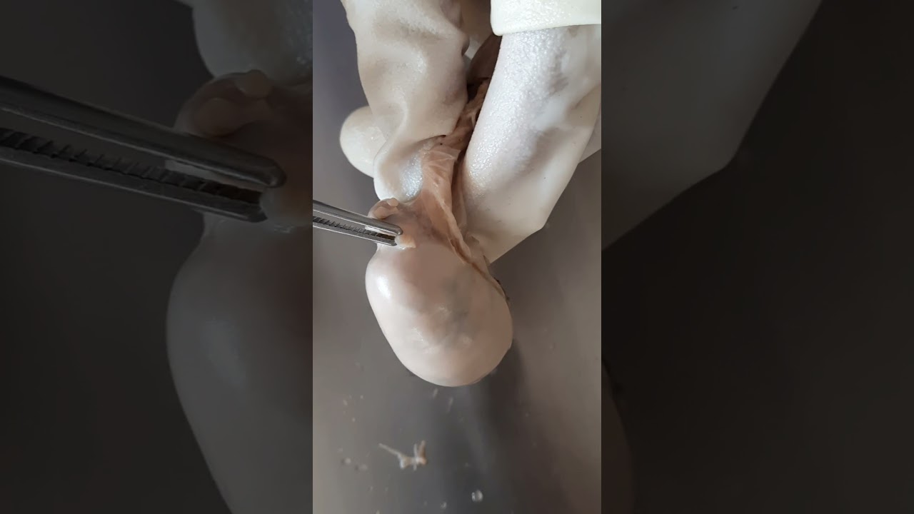 Appendix of Testis and Appendix of Epididymis