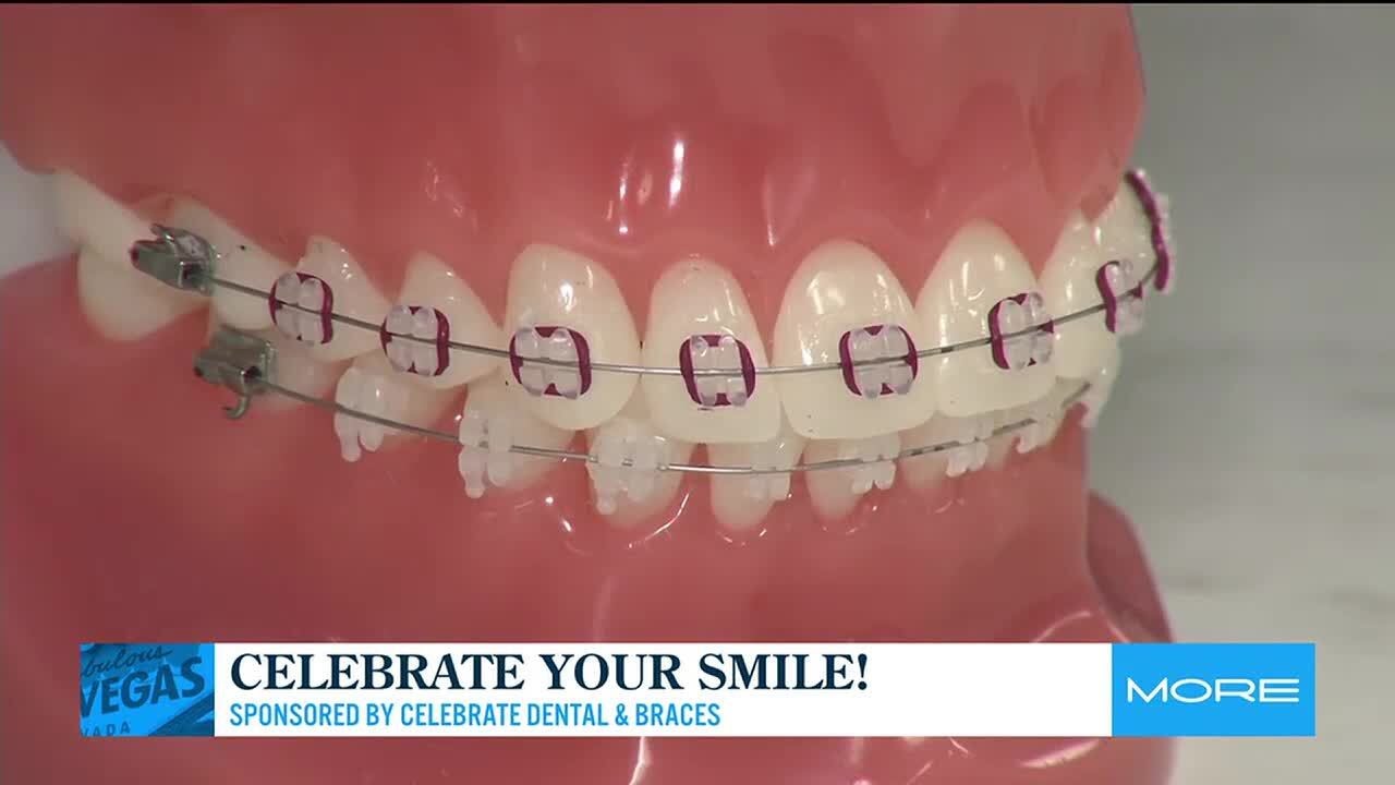 Affordable braces at Celebrate Dental