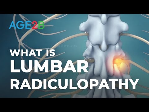 What Is Lumbar Radiculopathy? | Lumbar Nerve Roots | Disc Bulge