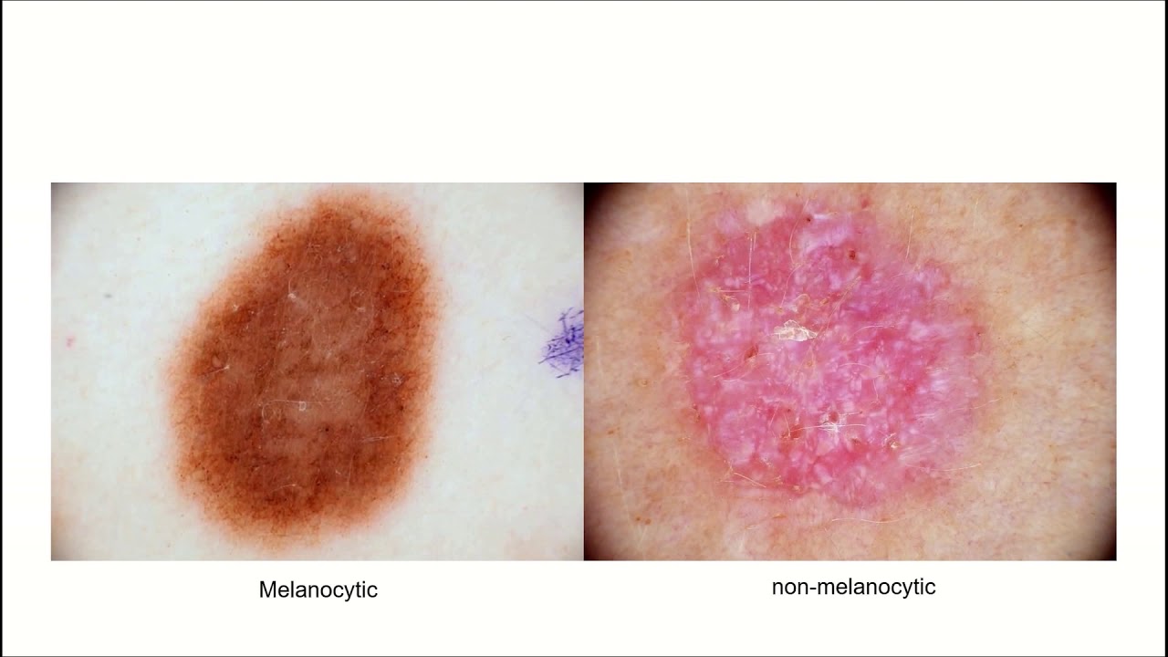 Simon Wells - Optimising Photo Dermoscopy Practice