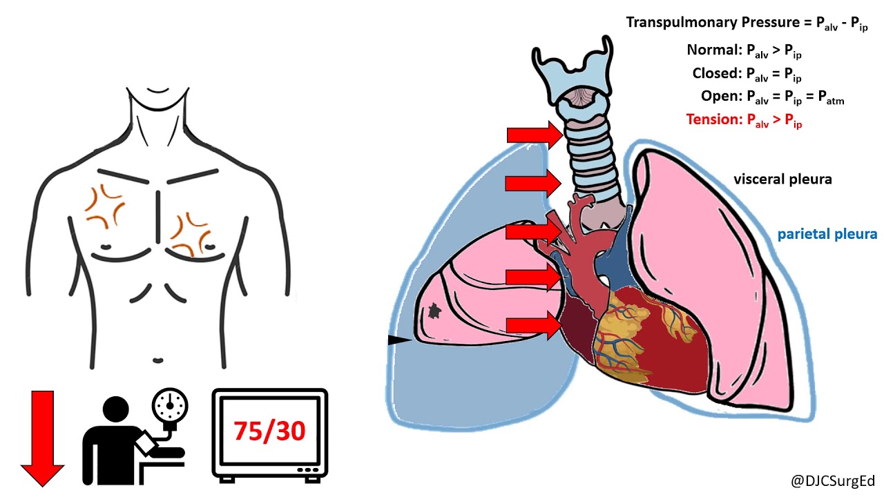 Thoracic Trauma