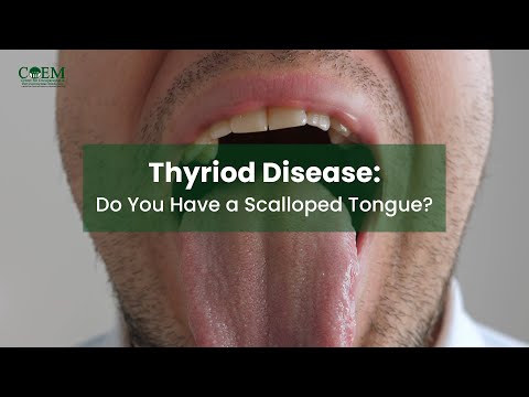 Thyroid Disease: Do You Have a Scalloped Tongue?