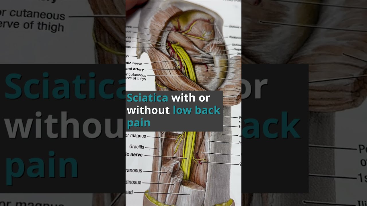 28 Years of Sciatica Pain Gone After Nerve Surgery with Dr. Eric Williams #sciaticnerve  #nervepain