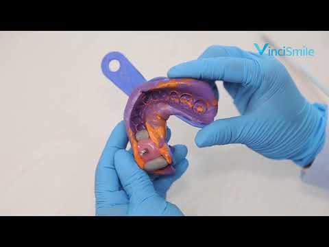 Artificial Gum in Implant Restoration