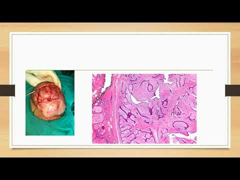 Phyllodes tumor