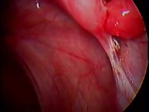 Pelvic Adhesion Removal from an Ovary during Laproscopic Fertility Surgery