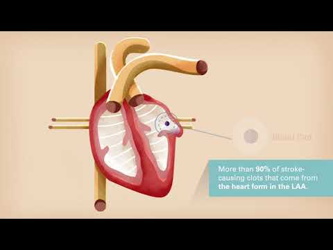 Understanding the WATCHMAN™ Procedure